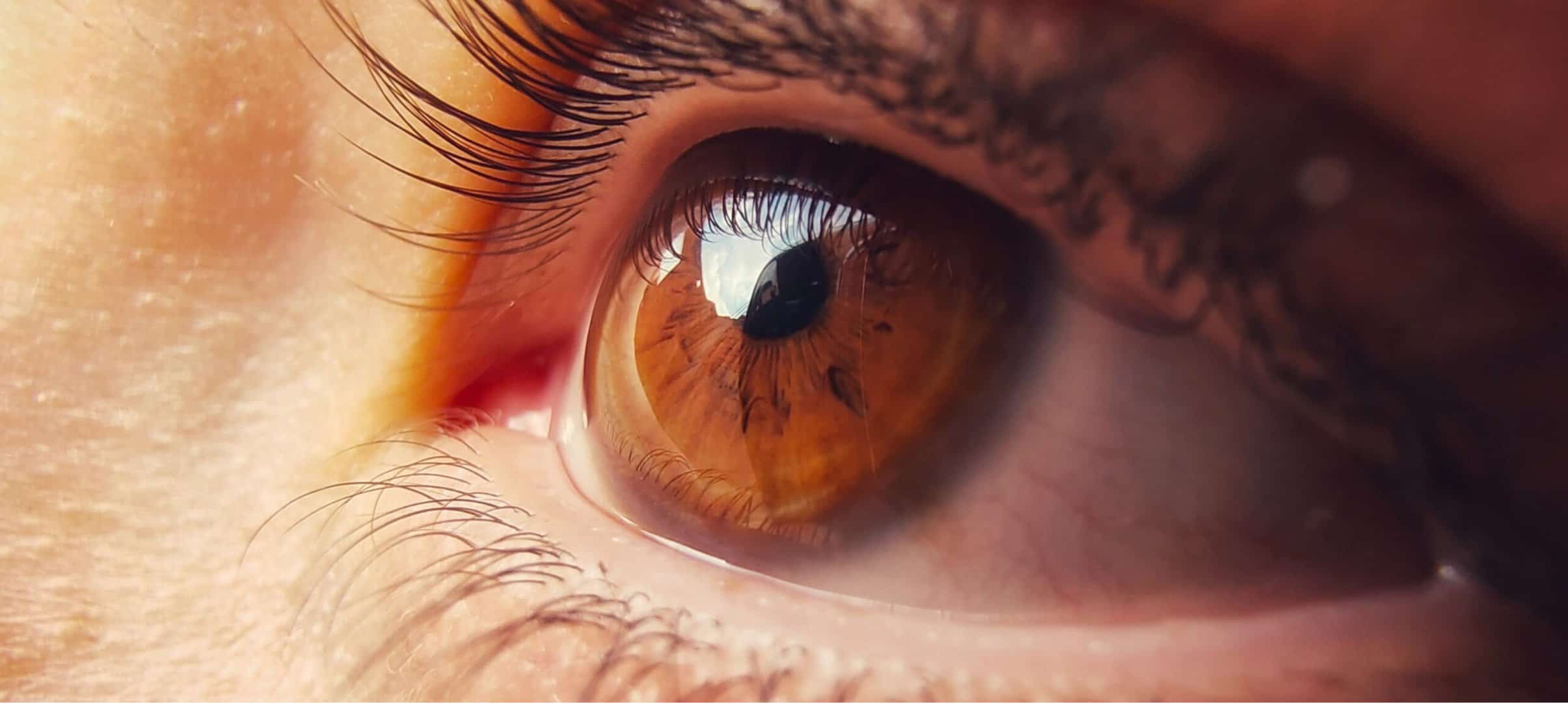 Ectropion - Sapphire Eye Care